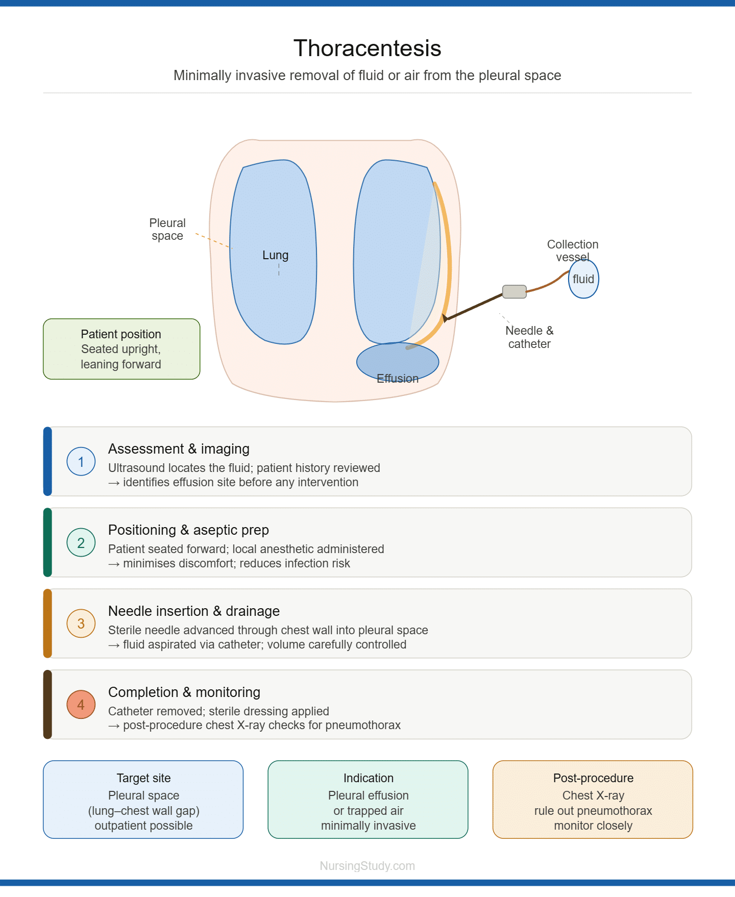 Thoracentesis in Nursing: A Comprehensive Step-by-Step Guide for Safe ...